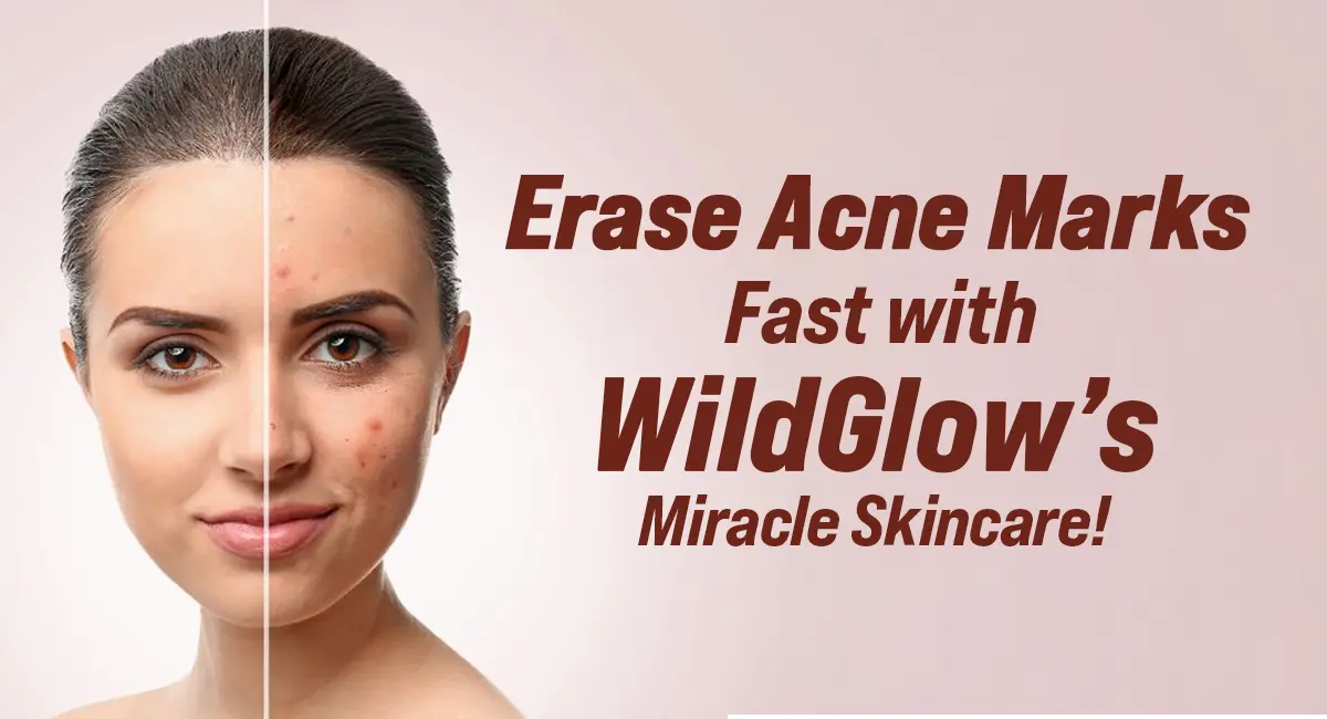 hyperpigmentation acne marks